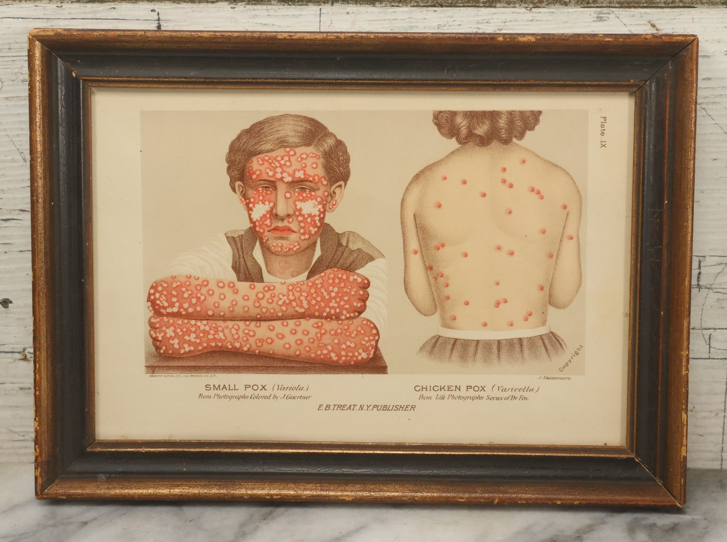 Lot 067 - Antique Skin Condition Medical Print, Small Pox & Chicken Po ...